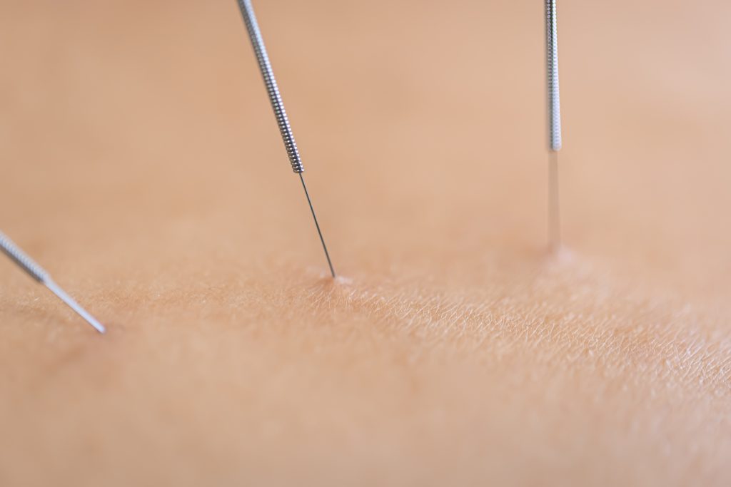 Welcome to Impact Dry Needling Clinic in Perth