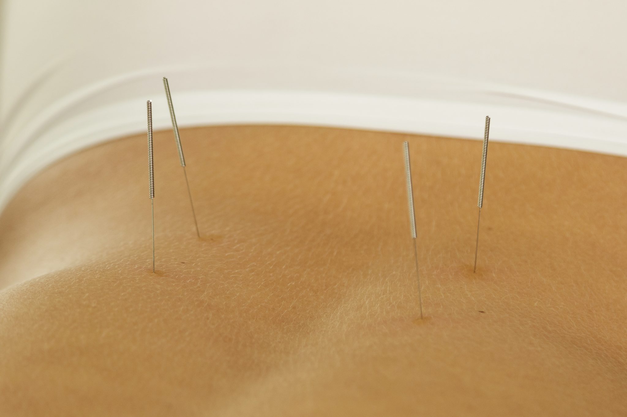 Understanding the Difference Between Dry Needling and Acupuncture ...