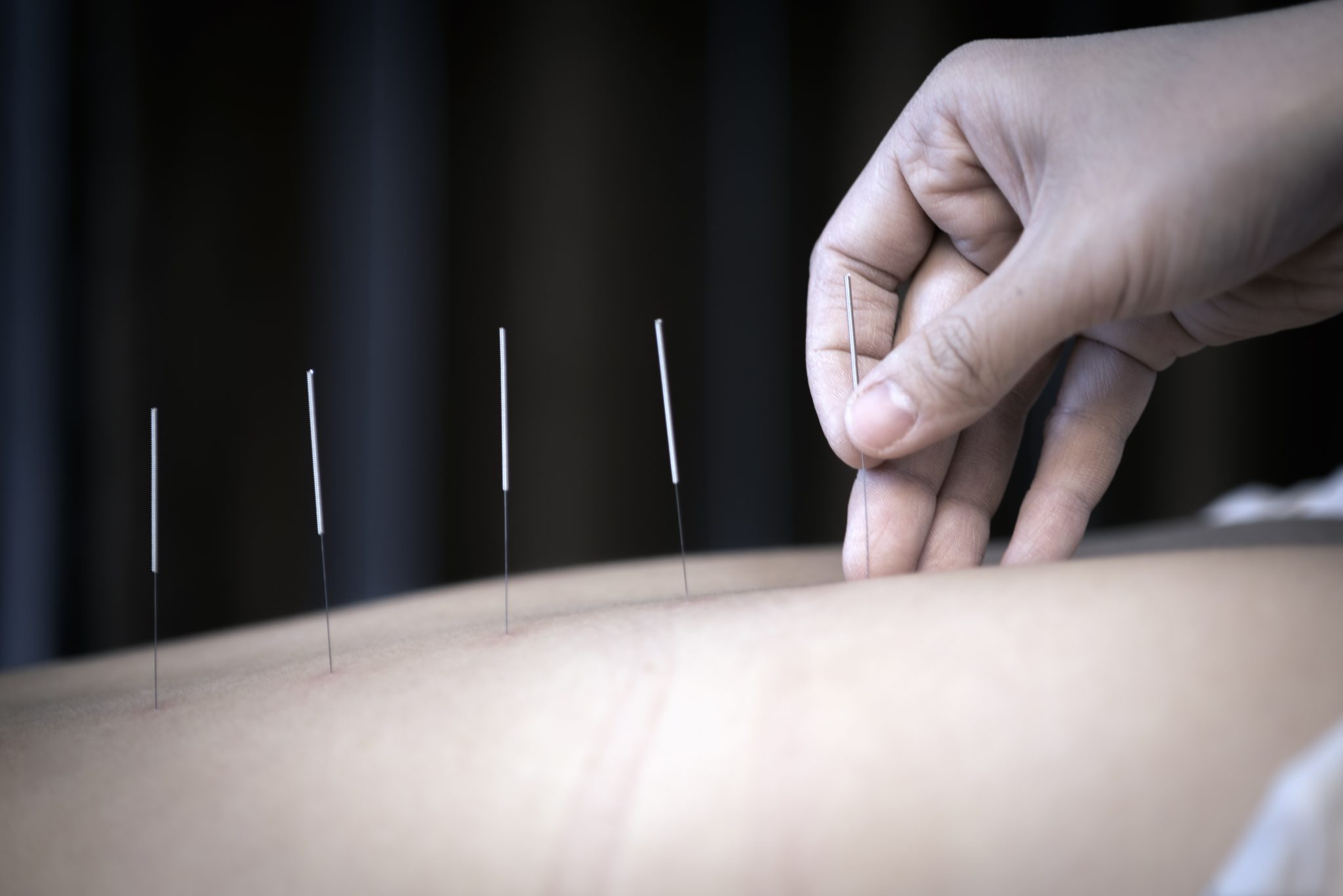 Understanding the Difference Between Dry Needling and Acupuncture ...